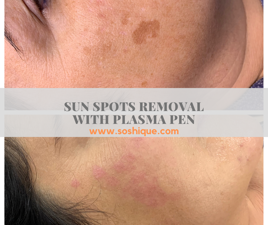 Skin Resurfacing with Plasma Pen for removal of sun/age spots ...